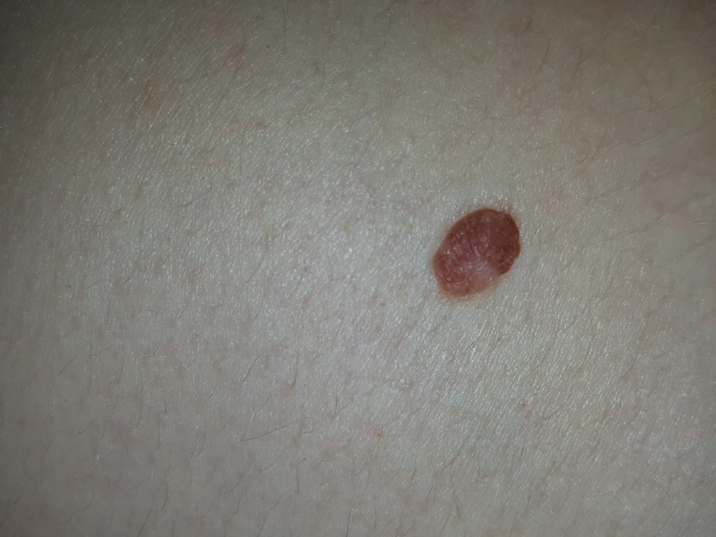 Lessons From My Big Fat Ugly Mole From Hell - manic-momday.com